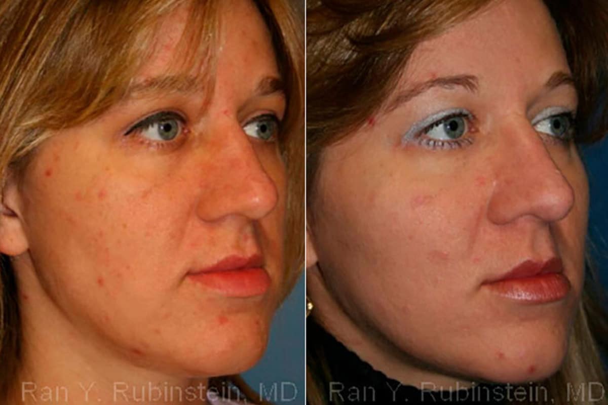 Are Cheek Implants Permanent