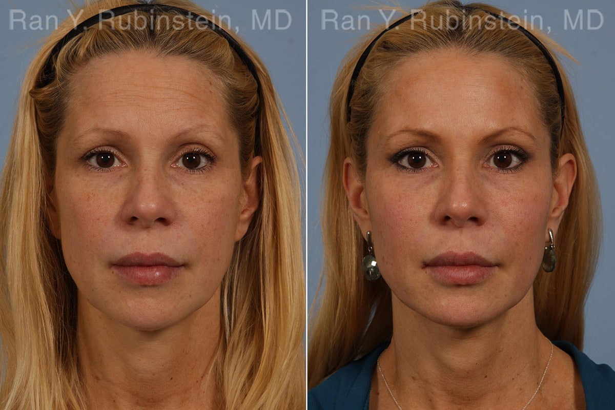 Liquid Facelift in Hudson Valley, NY