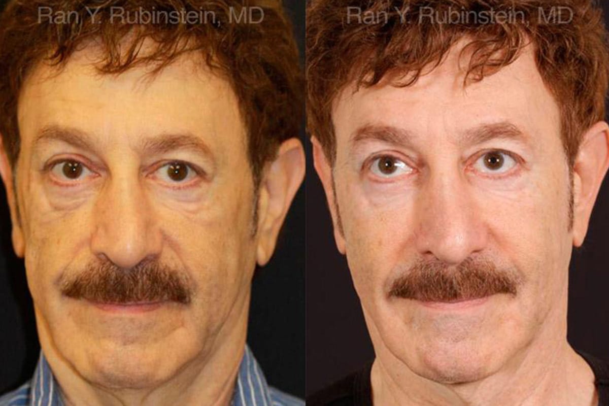 Restylane | Newburgh, NY | Dr. Rubinstein