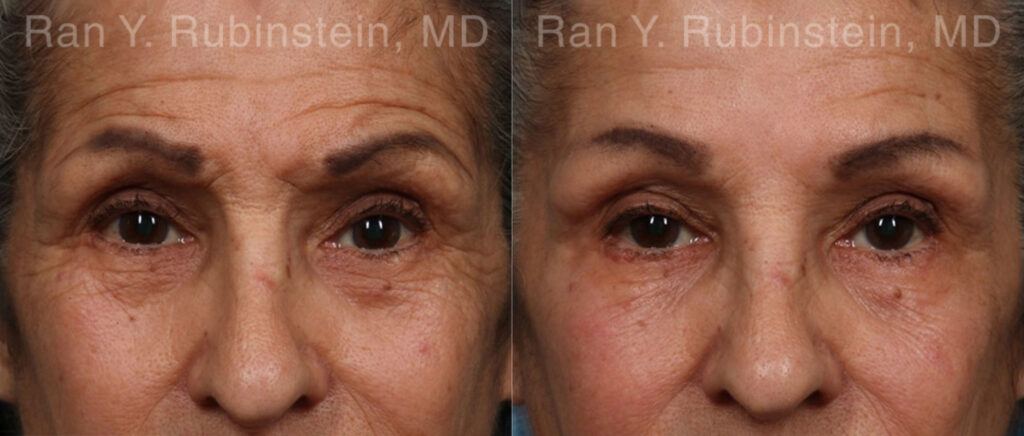 Botox in Newburgh, NY | Hudson Valley | Dr. Ran Rubinstein