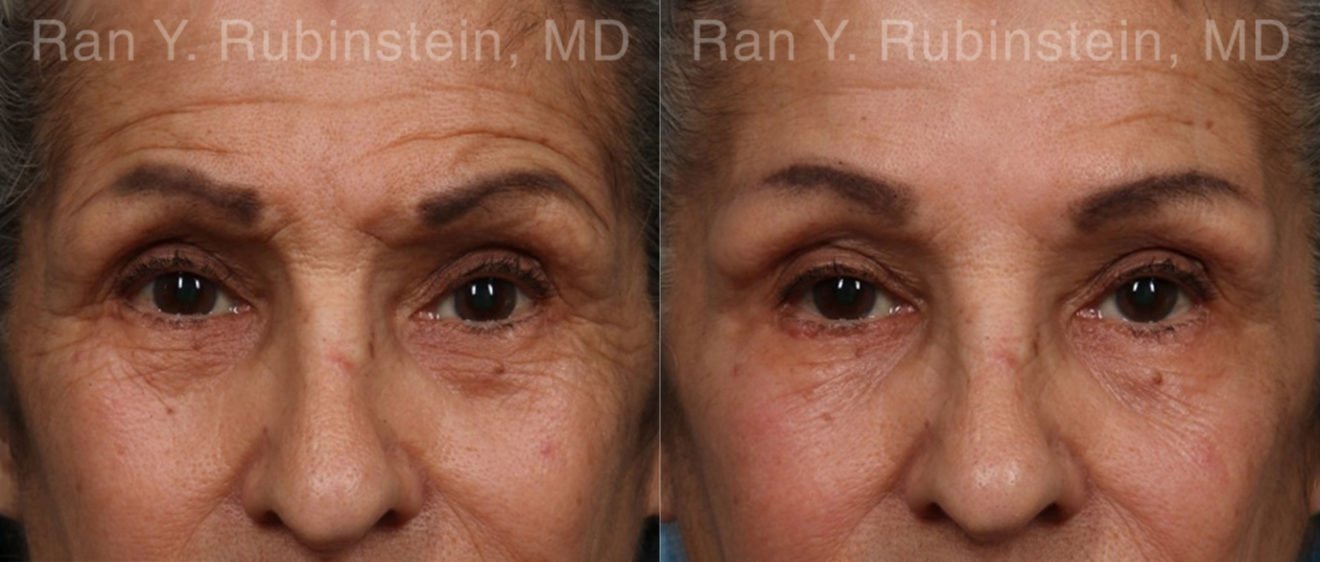 Botox in Newburgh, NY | Hudson Valley | Dr. Ran Rubinstein