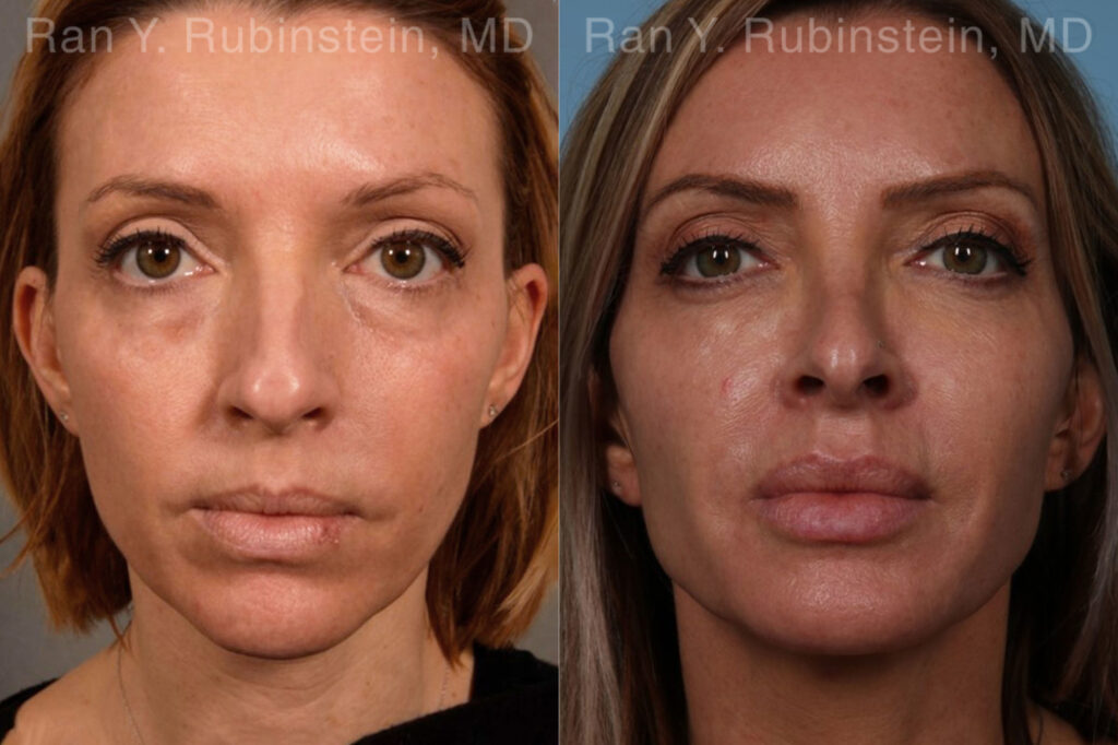 Sculptra Face In Newburgh Ny Ran Y Rubinstein Md
