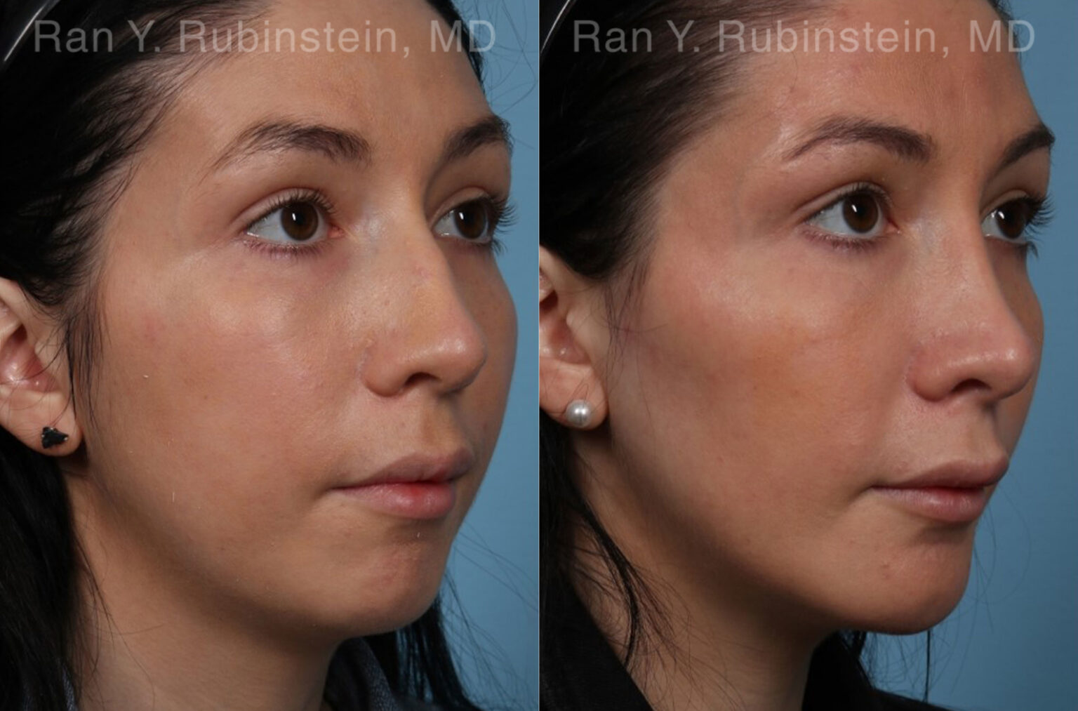 How to Get Rid of a Cleft Chin | Dr. Ran Rubinstein