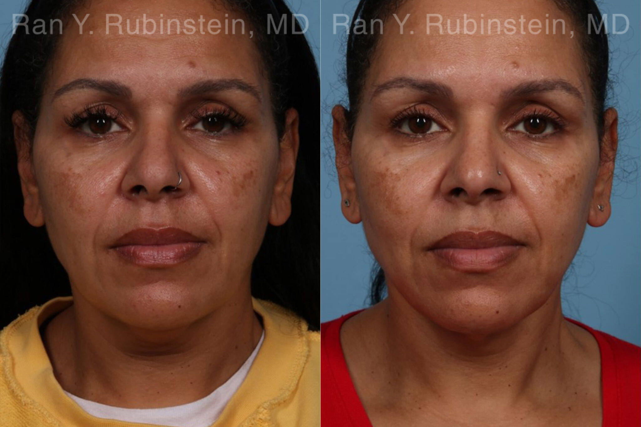Precision TX Laser in Newburgh, NY | Ran Y. Rubinstein, MD
