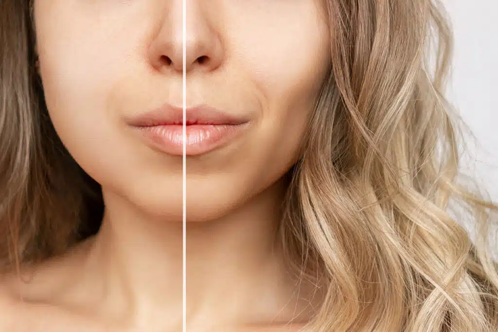 Buccal Fat Removal vs. Cheek Liposuction: Key Differences Buccal Fat Removal vs. Cheek Liposuction: Key Differences