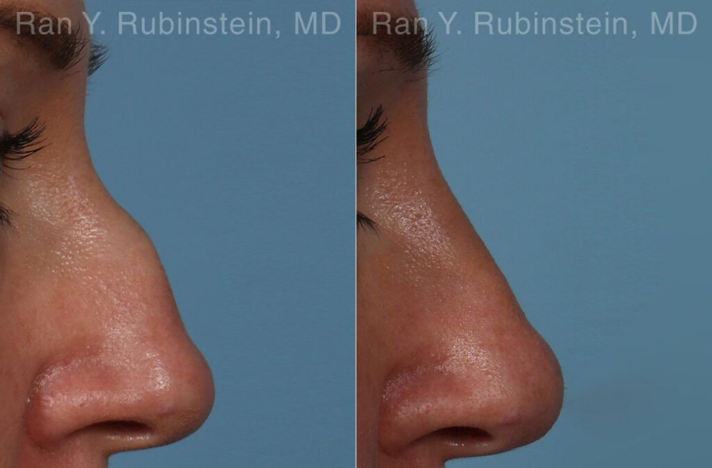 Can Liquid Rhinoplasty Make Your Nose Smaller?
