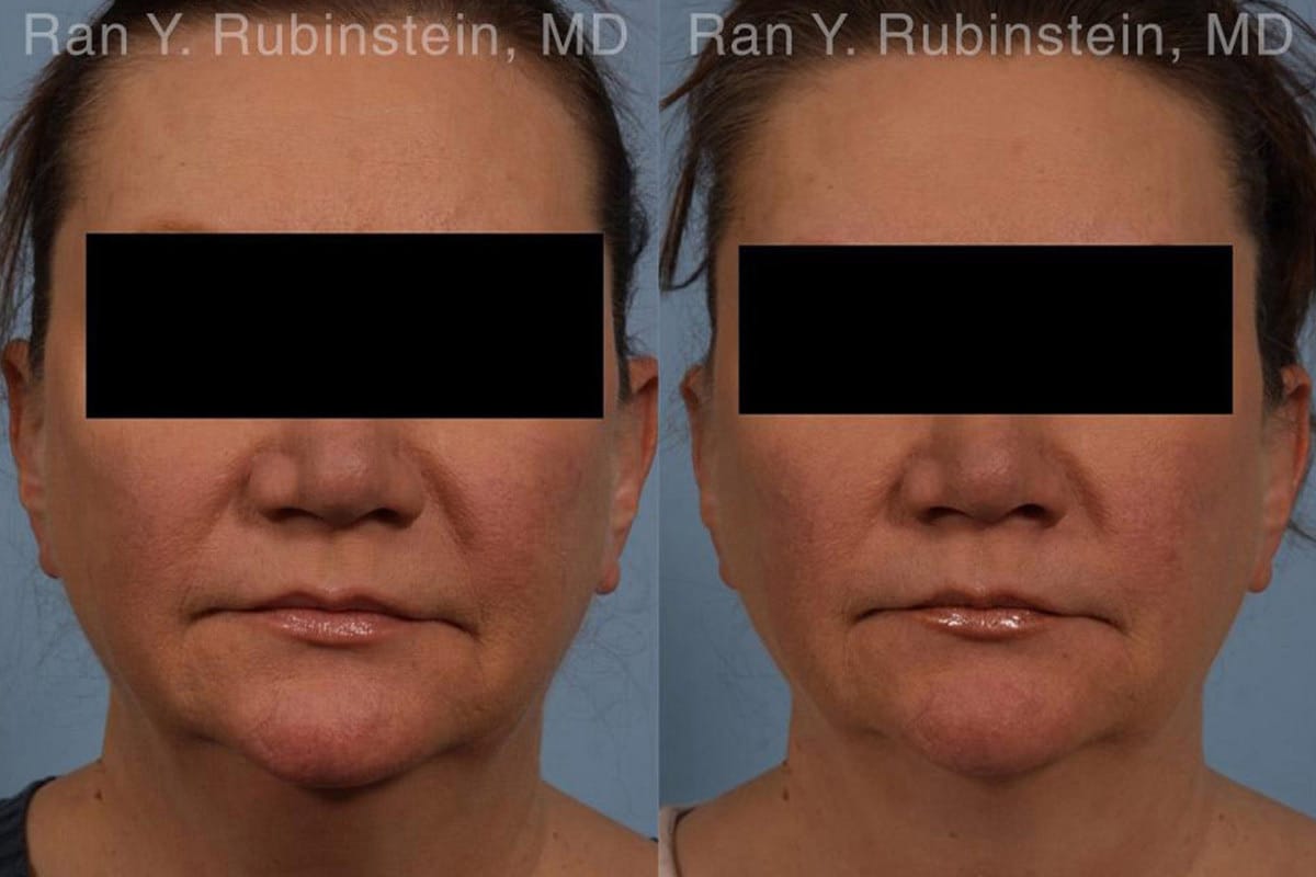 Coolsculpting Neck in Newburgh, NY | Dr. Ran Y. Rubinstein