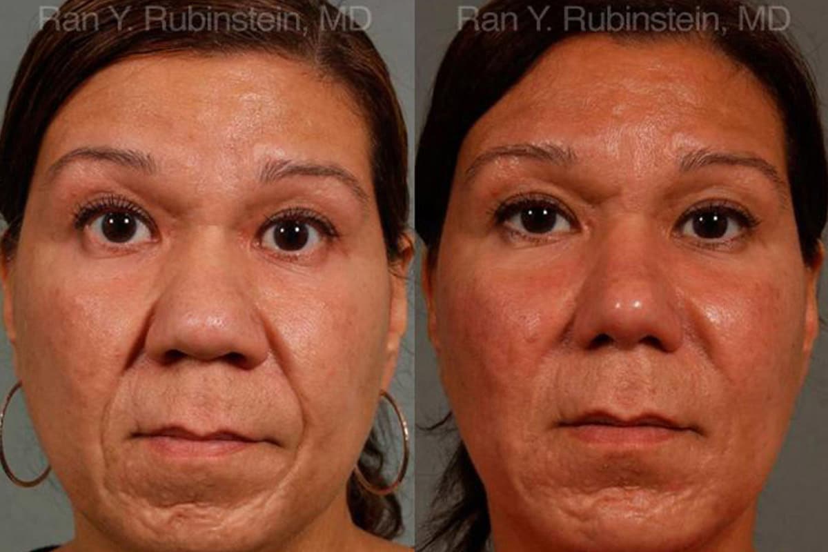 Ethnic Rhinoplasty in Newburgh, NY | Ran Y. Rubinstein, MD