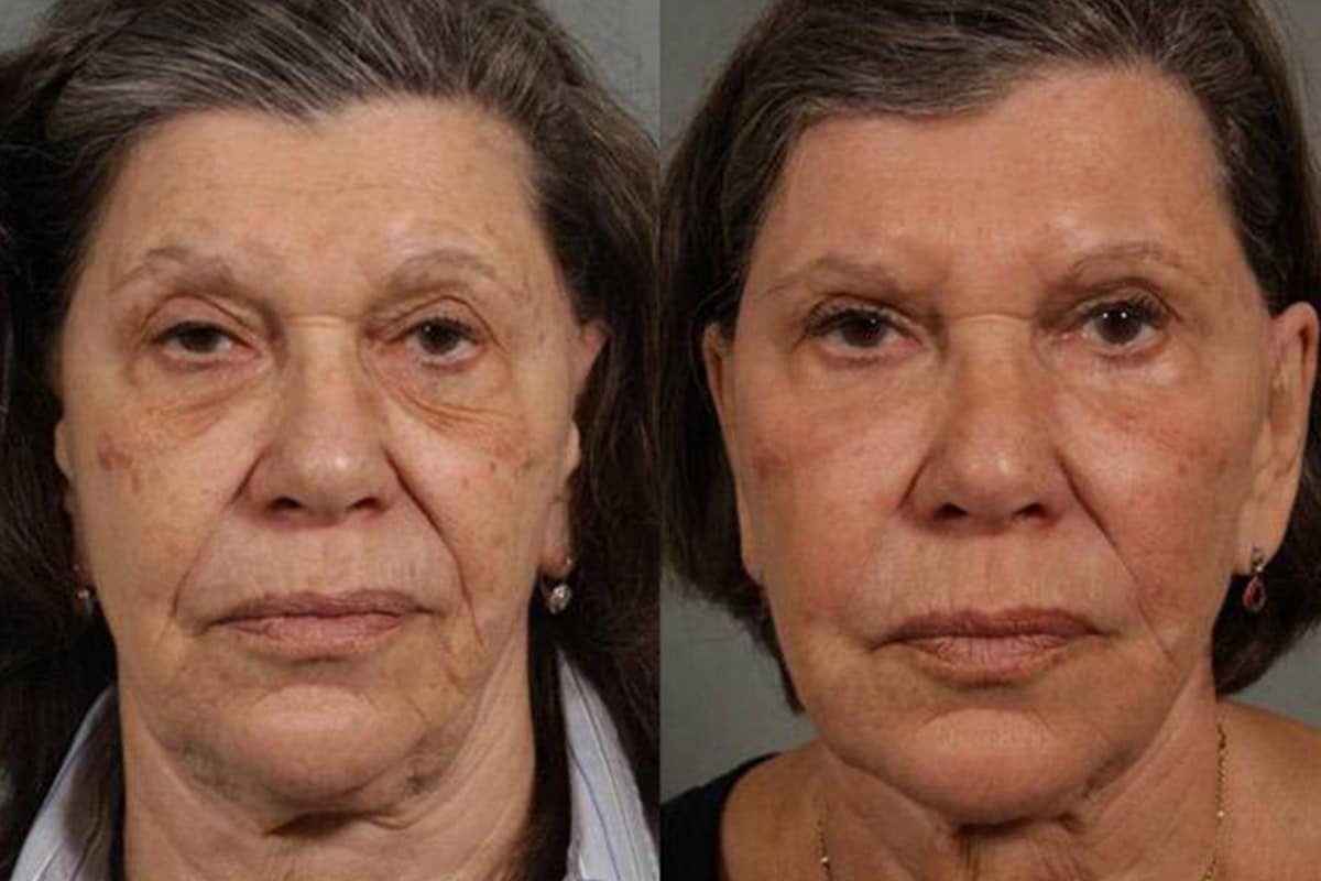 Laser Resurfacing in Newburgh, NY | Ran Y. Rubinstein, MD