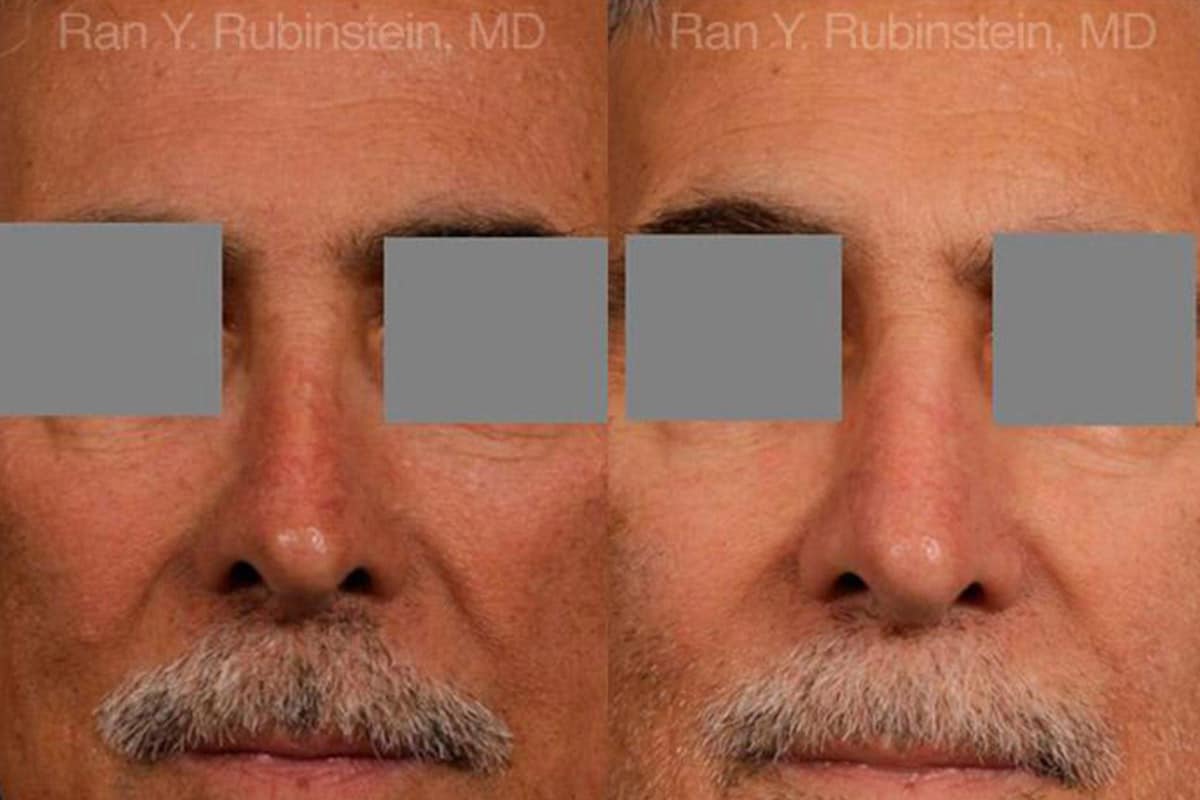 Non-Surgical Rhinoplasty Newburgh, NY | Dr. Ran Rubinstein