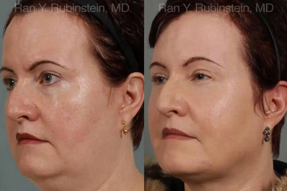 Precision TX Laser in Newburgh, NY | Ran Y. Rubinstein, MD