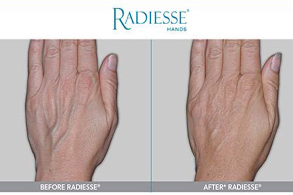 Radiesse Hand Rejuvenation Newburgh, NY | Dr. Rubinstein