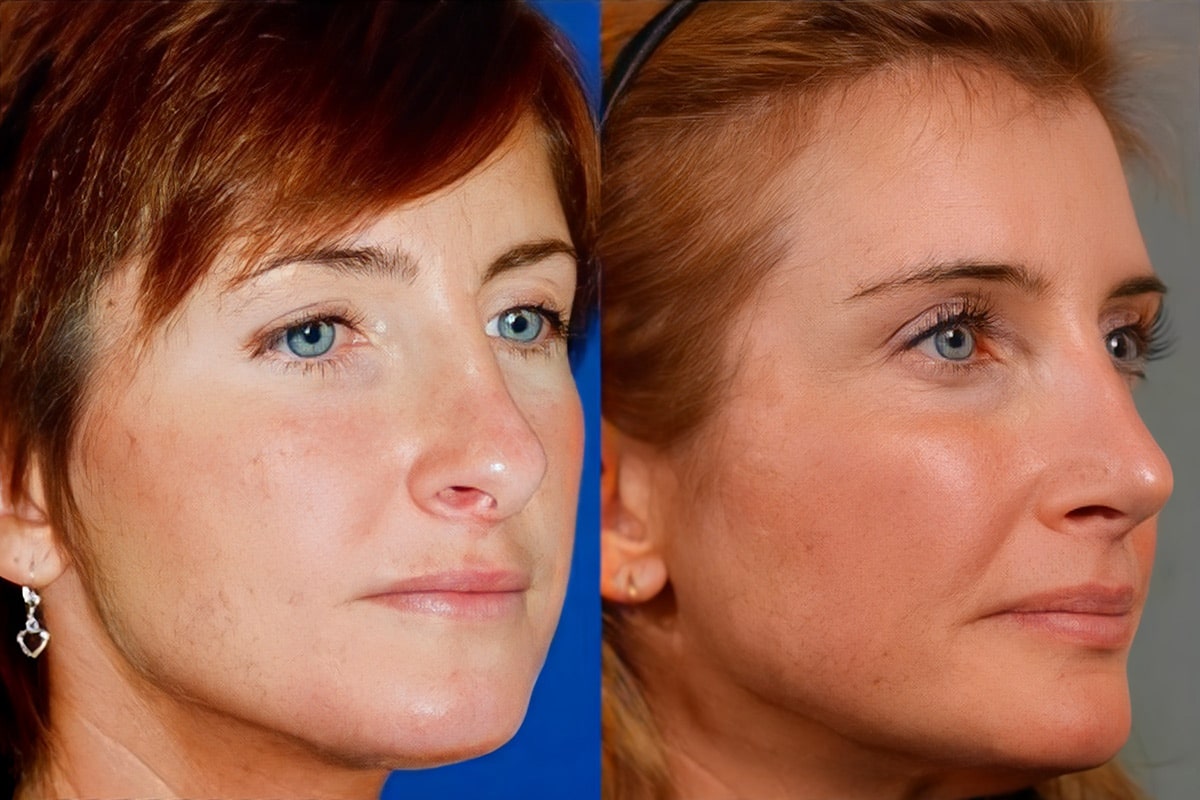Revision Rhinoplasty in Newburgh, NY | Dr. Ran Rubinstein