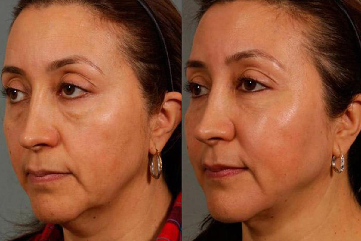 Neck Liposuction in Newburgh, NY | Ran Y. Rubinstein, MD