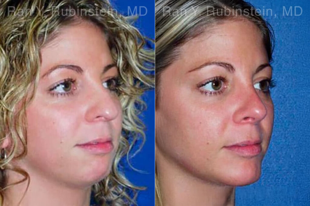 How to Get Rid of a Cleft Chin | Dr. Ran Rubinstein