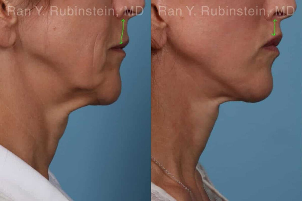 Explaining the Different Types of Lip Lift Techniques